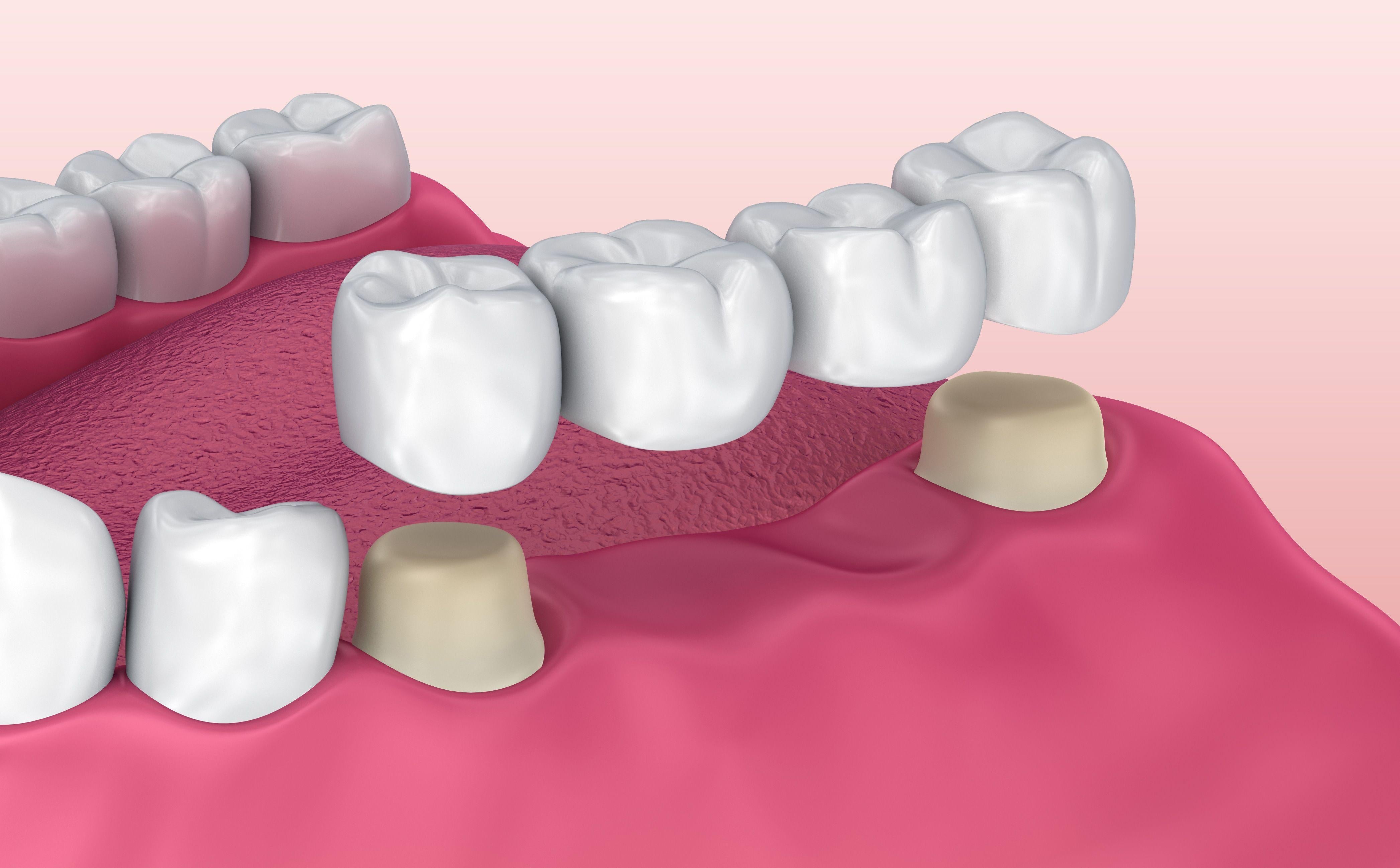 O que é uma Ponte Dentária? Tipos, Custos e Prevenção | Oclean