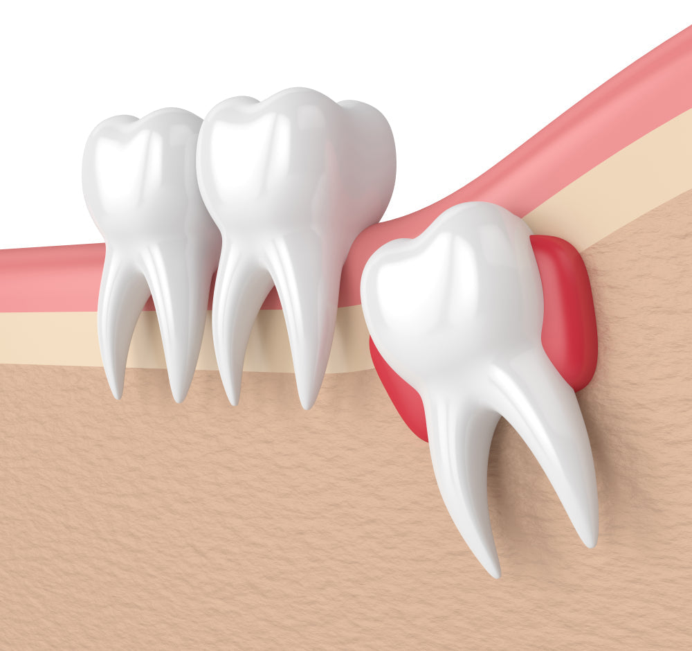 Quando Nascem os Dentes do Siso? Guia de Sinais, Sintomas e Tratamento
